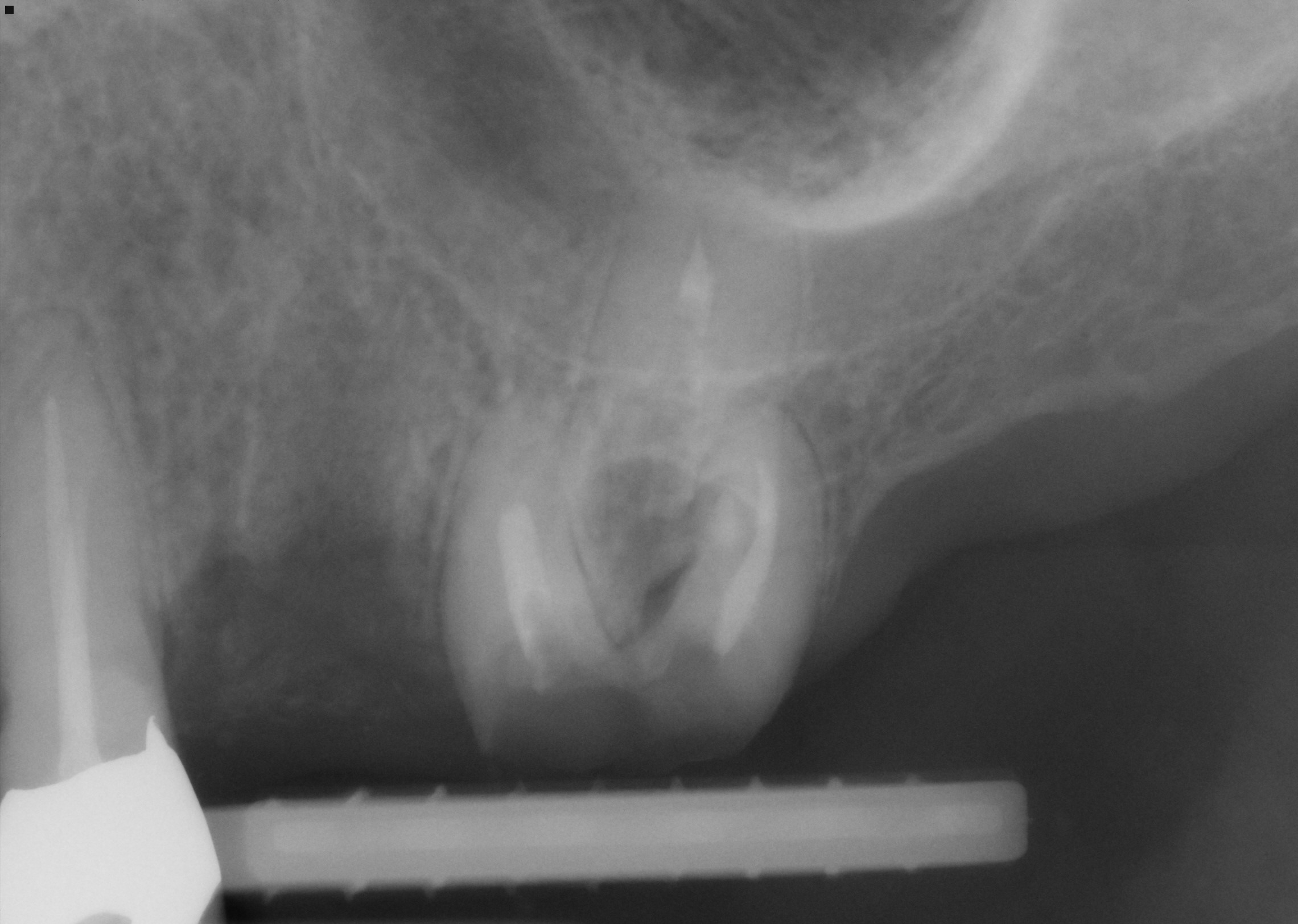 Dental News - Maxillary first molar atraumatic extraction