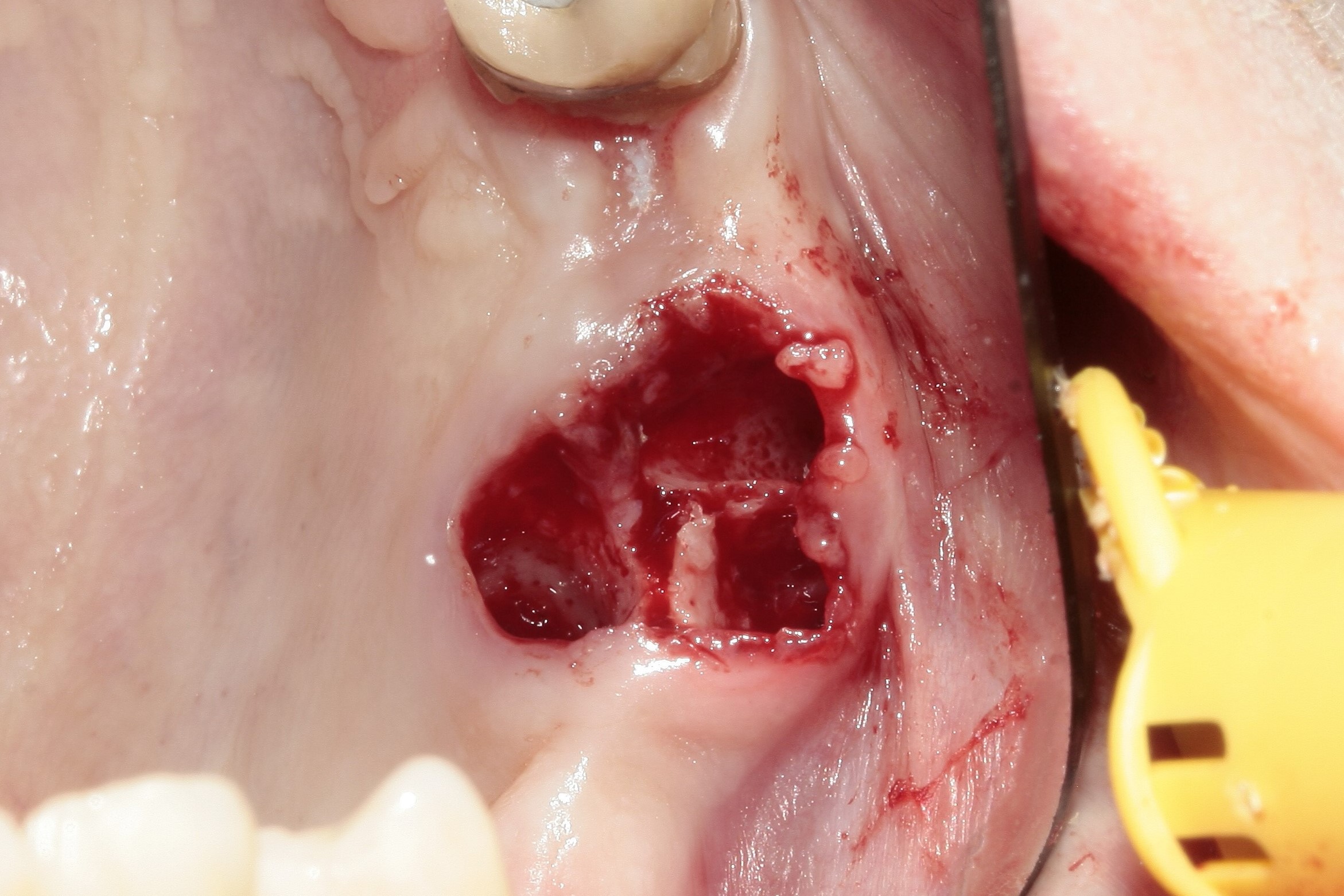 Dental News - Maxillary first molar atraumatic extraction
