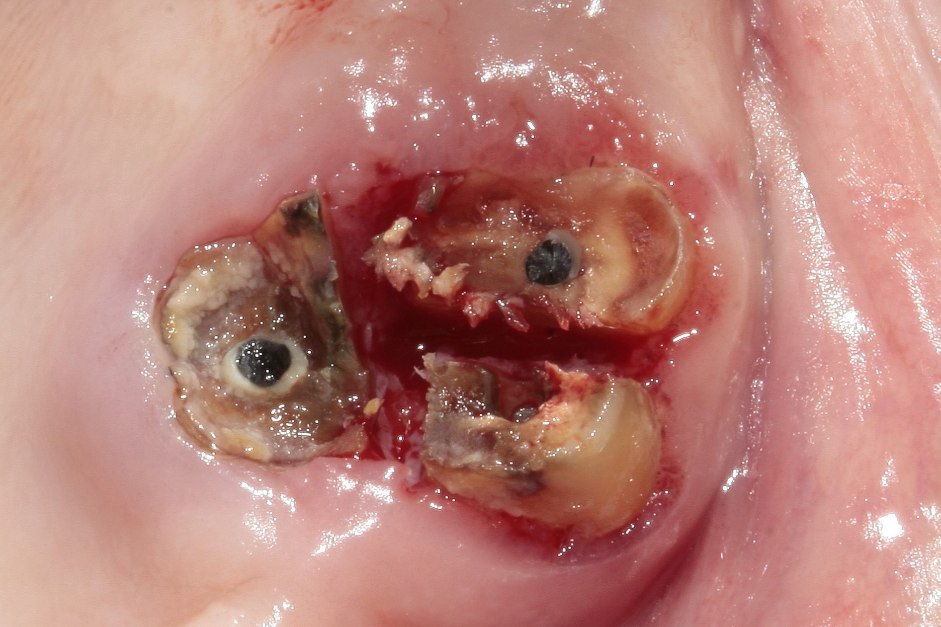 Dental News - Maxillary first molar atraumatic extraction