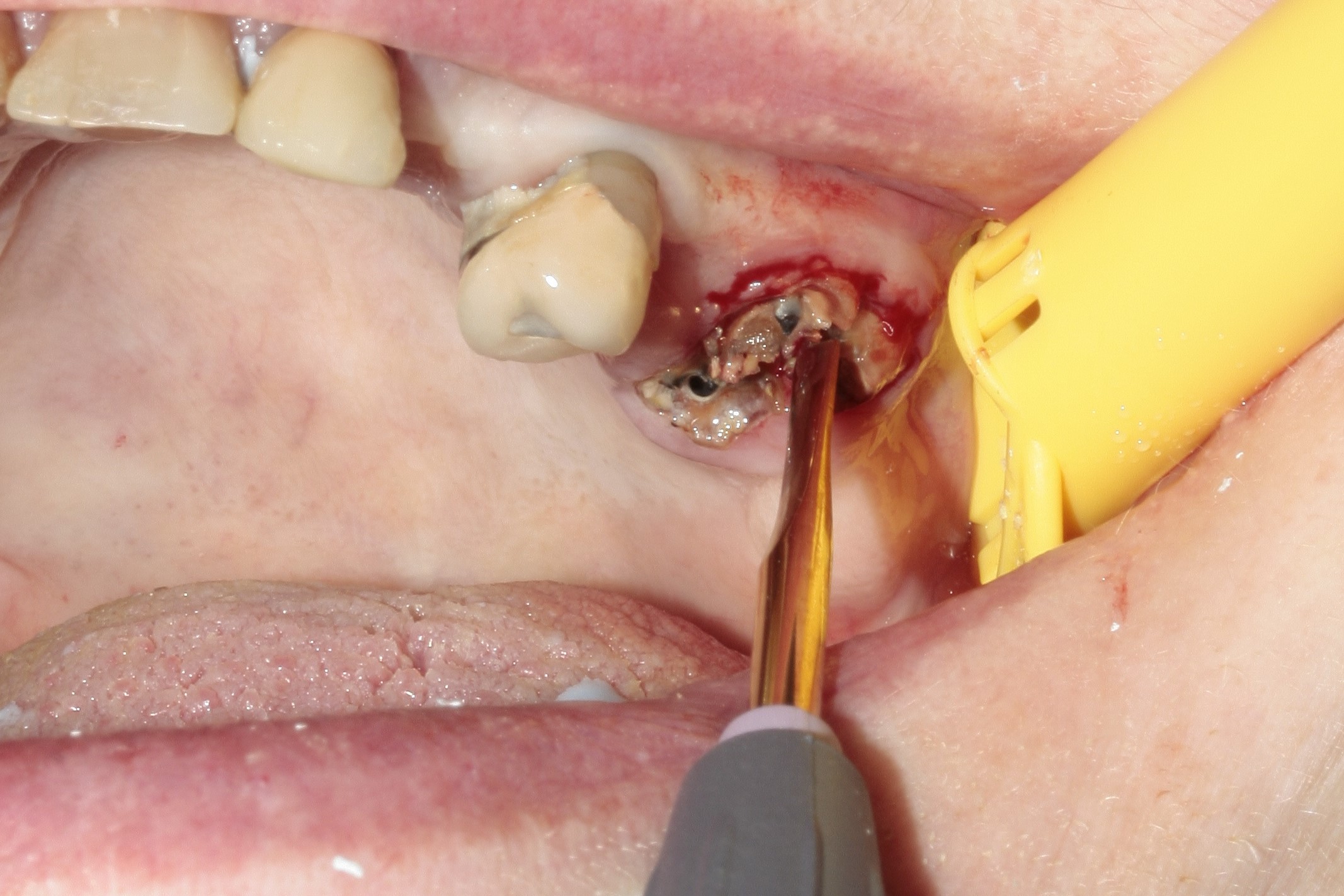 Dental News - Maxillary first molar atraumatic extraction