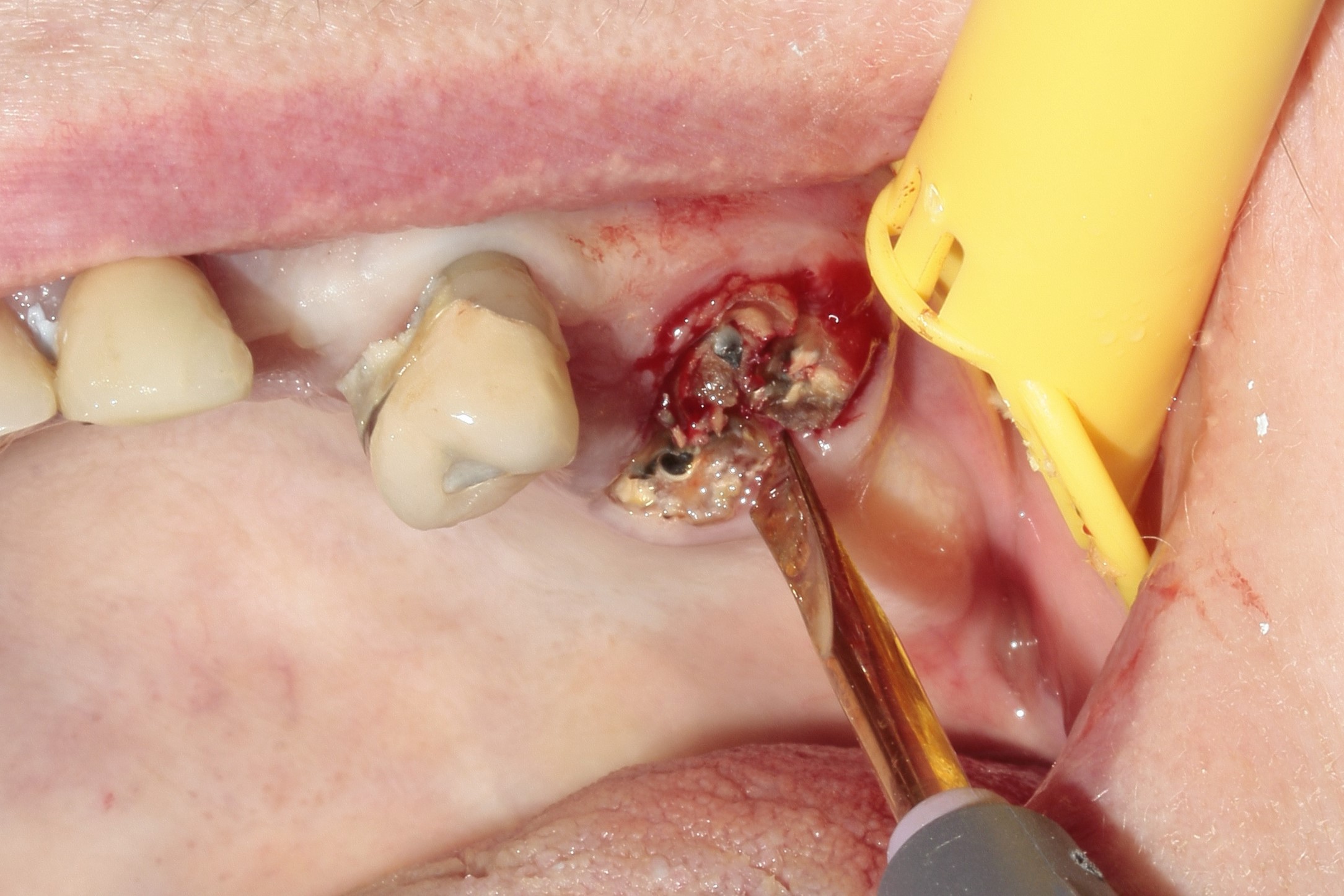 Dental News - Maxillary first molar atraumatic extraction