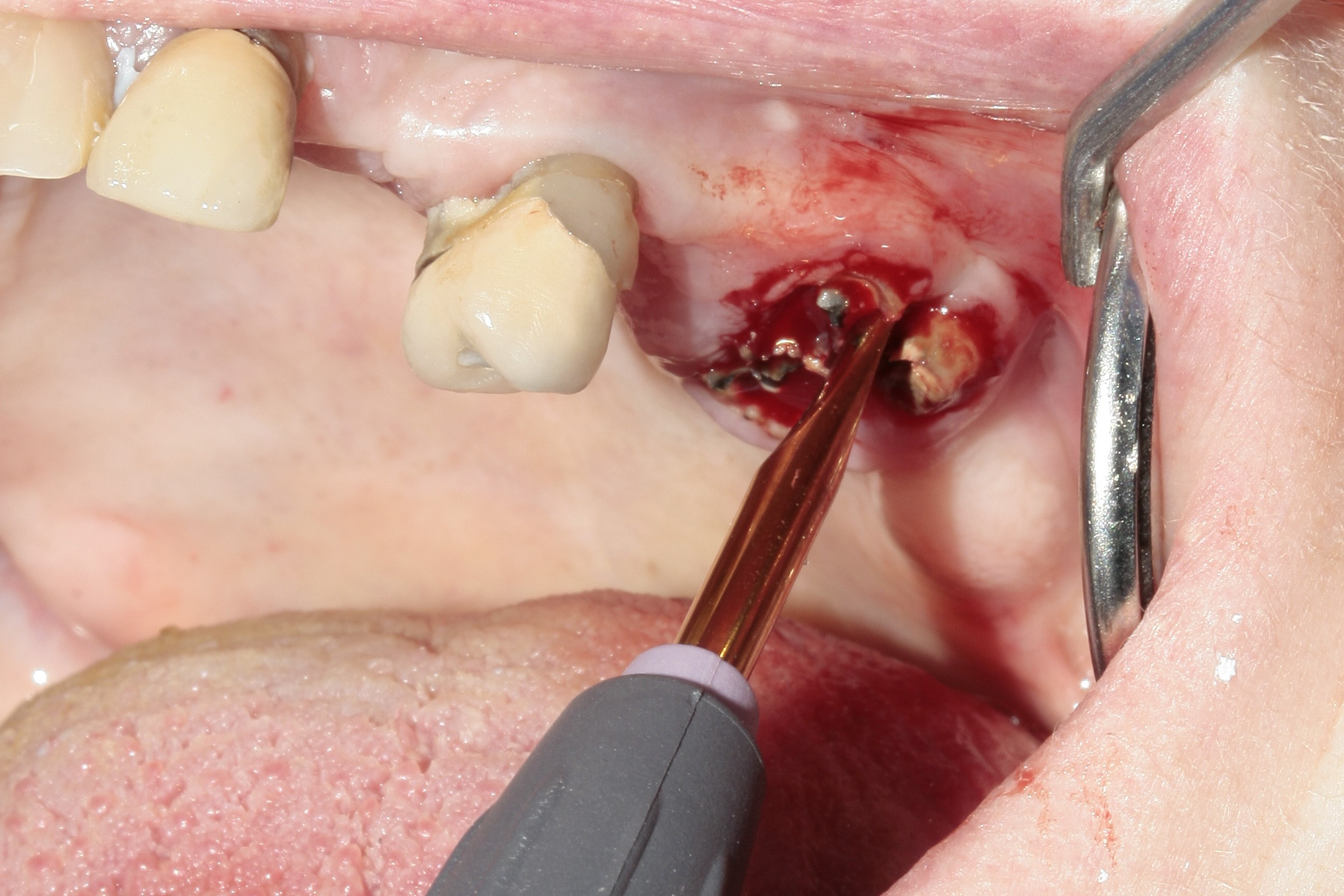Dental News - Maxillary first molar atraumatic extraction