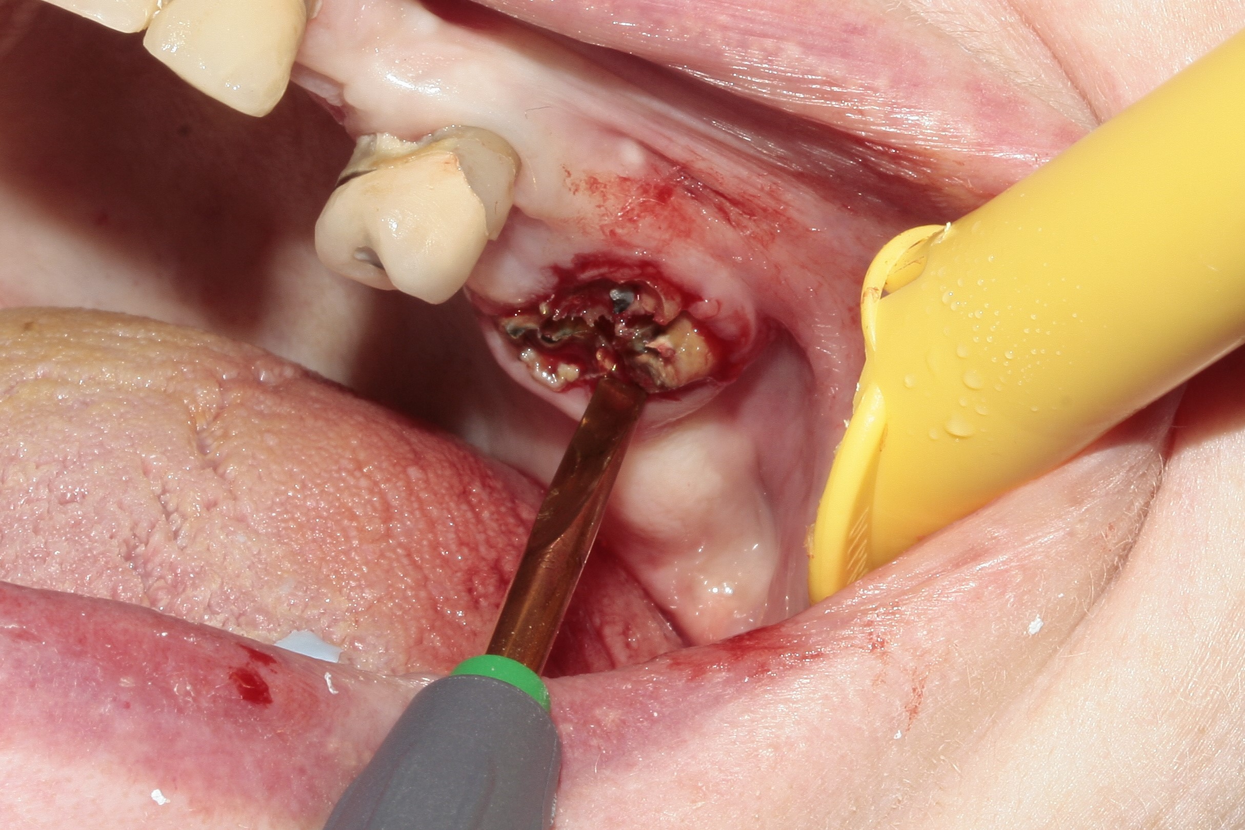 Dental News - Maxillary first molar atraumatic extraction