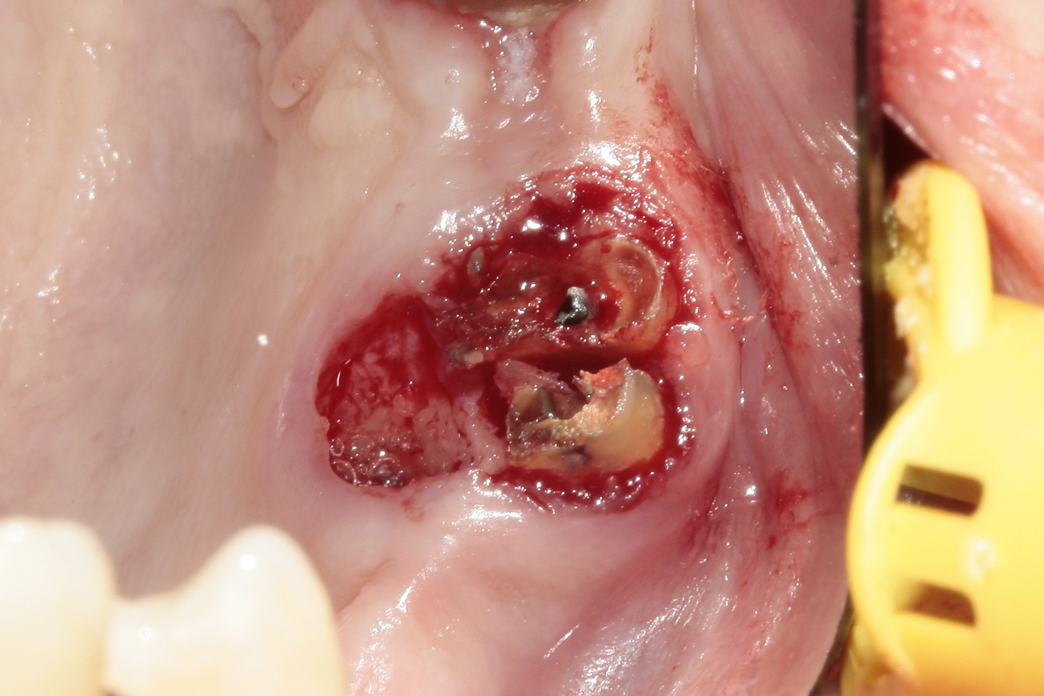 Dental News - Maxillary first molar atraumatic extraction