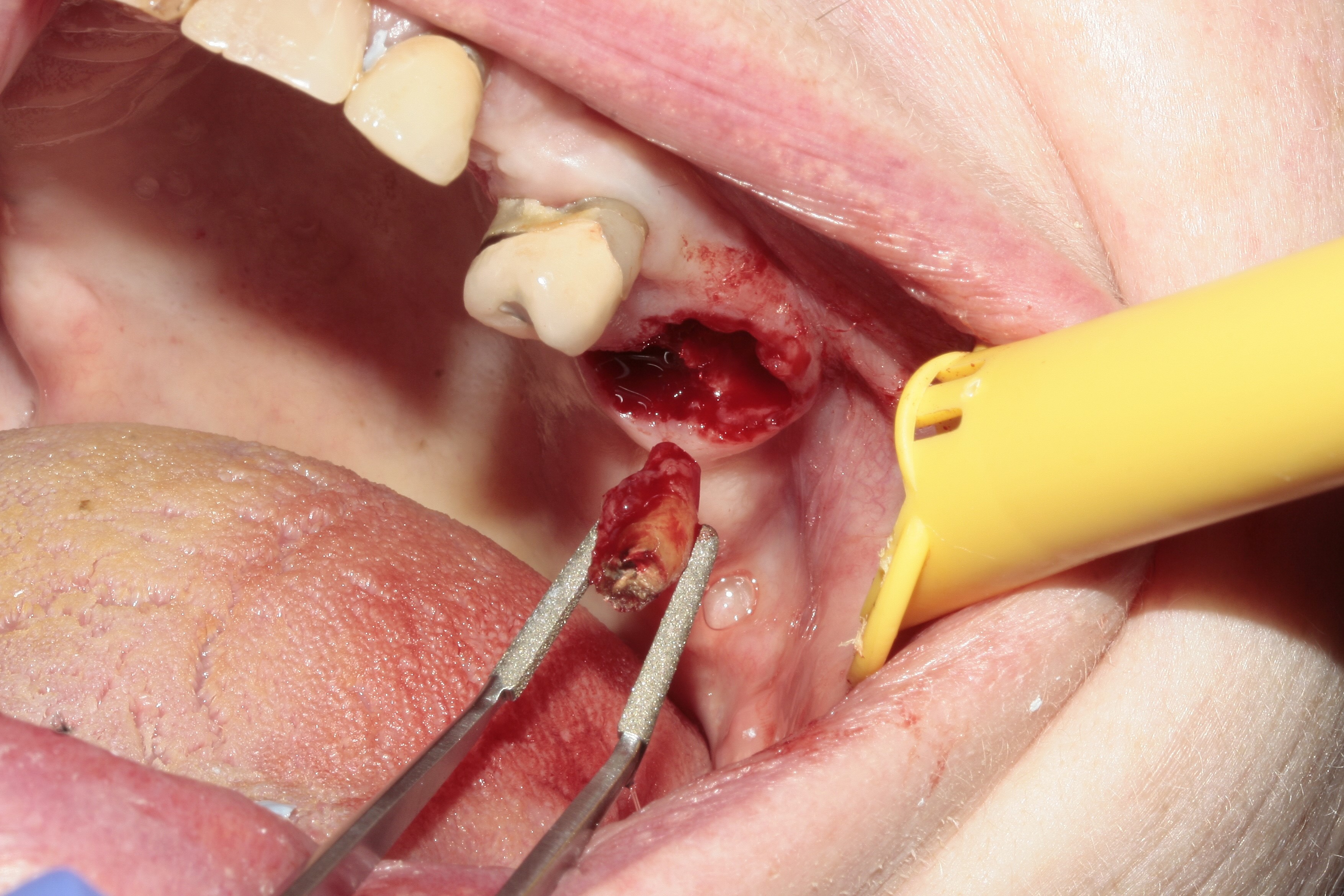 Dental News - Maxillary first molar atraumatic extraction