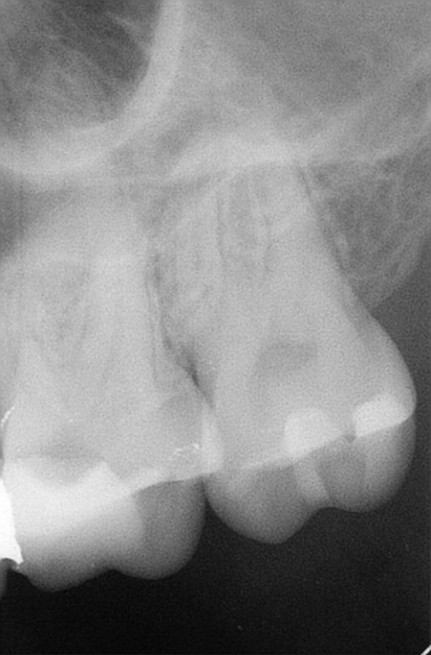 Endodontic treatment of maxillary left first molar