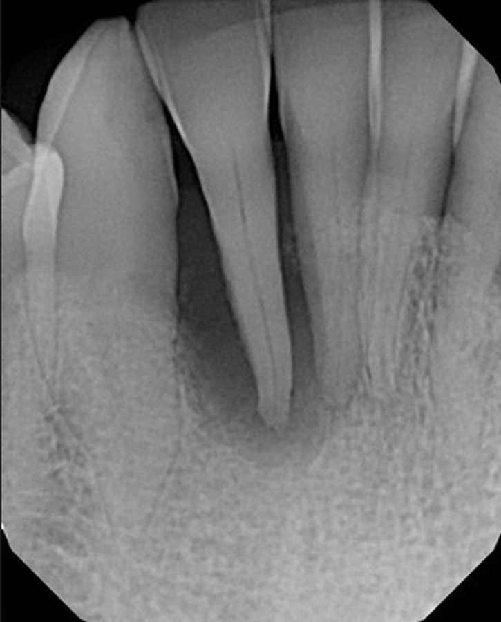 Implant placement in narrow spaces